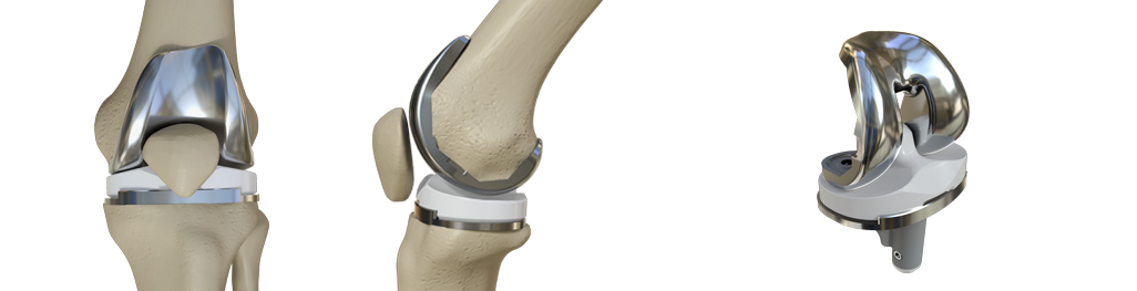 Unique Knee System IRENE